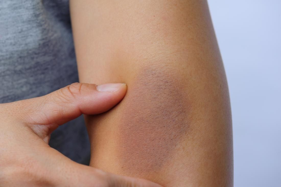 Cuánto tiempo duran los moretones y qué significan sus colores