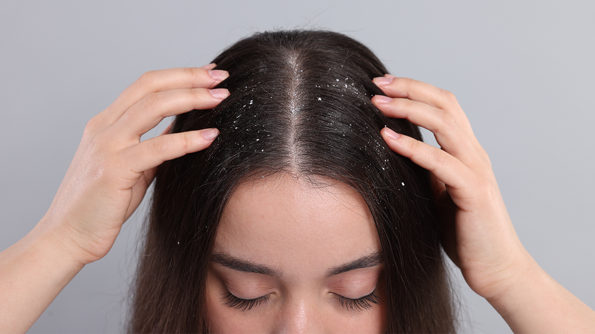La solución barata y natural para la caspa que debes recomendar