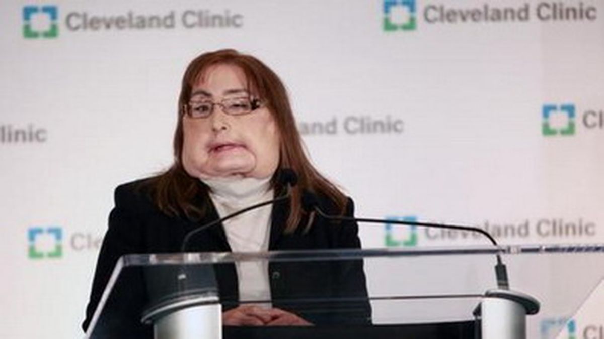 Presentan a la mujer que se le practicó un trasplante de cara