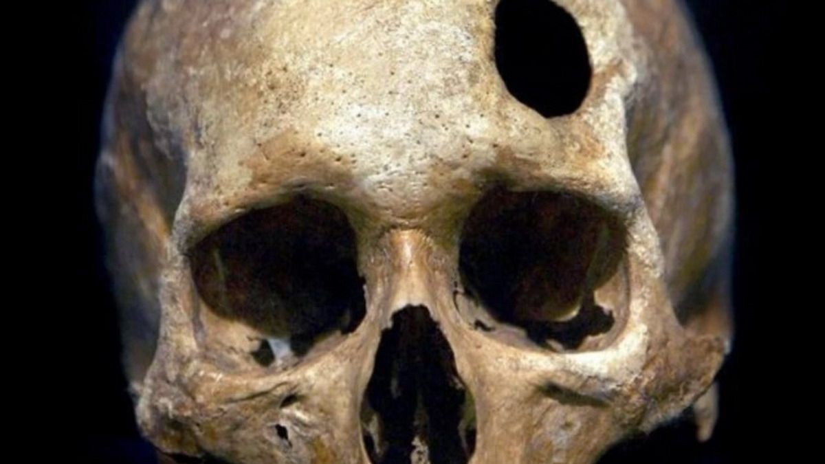 Increíble hallazgo arqueológico: audaz trepanación médica en la prehistoria